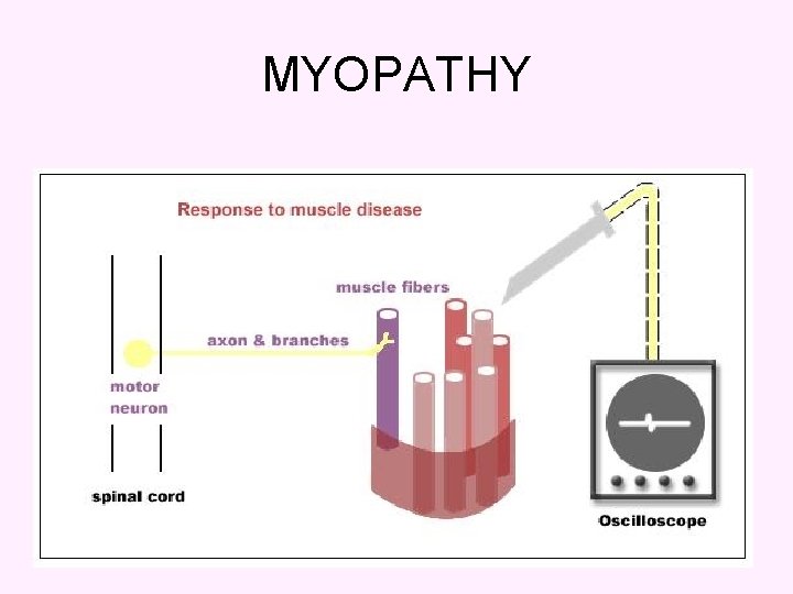 ELECTROMYOGRAPHY AND MOTOR NERVE CONDUCTION VELOCITY ELECTROMYOGRAPHY EMG