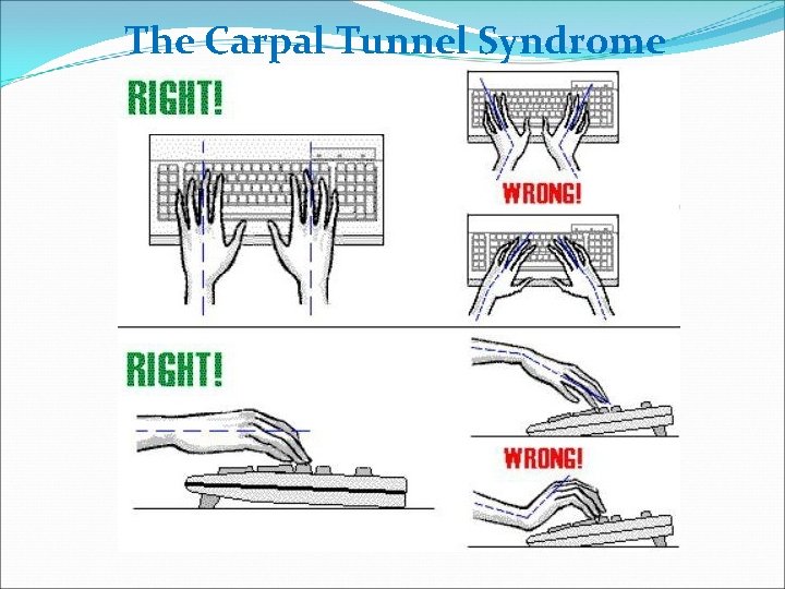 The Carpal Tunnel Syndrome For all computer users
