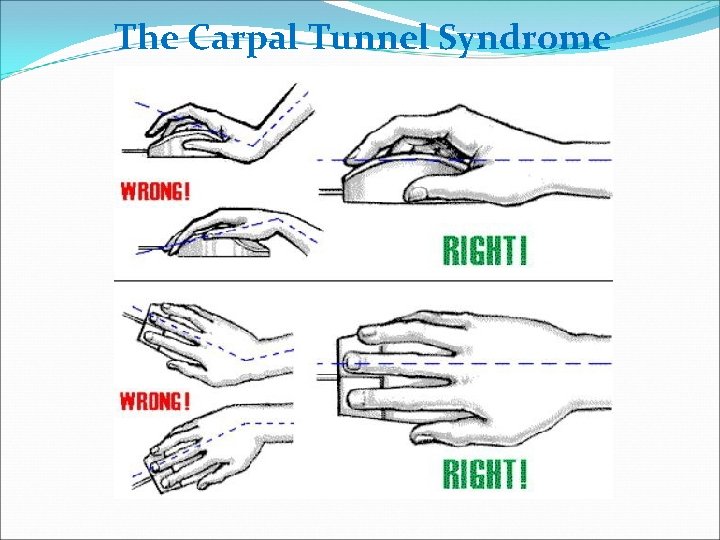 The Carpal Tunnel Syndrome For all computer users