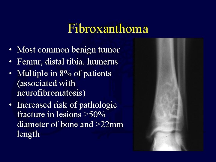 Pathologic Fractures H T Temple MD Walter W