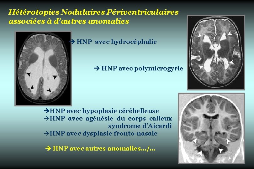 Htrotopies Pachygyries et Lissencphalies Dr C FalletBianco Paris