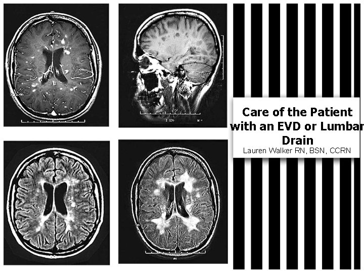 Care of the Patient with an EVD or
