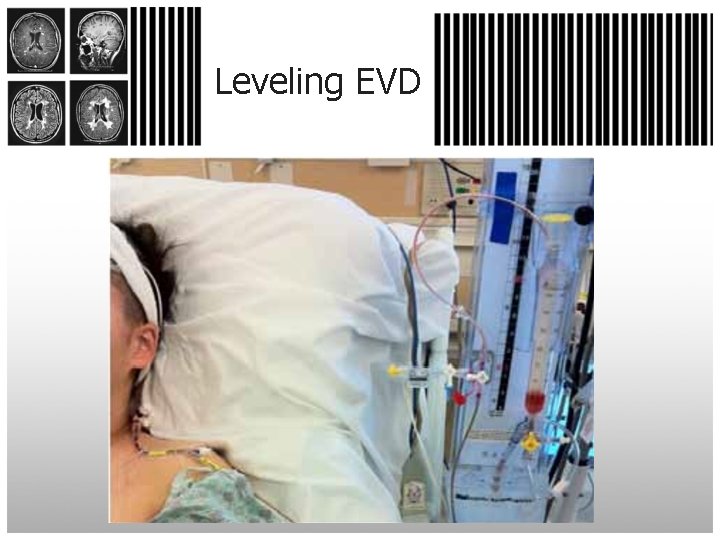 Care of the Patient with an EVD or