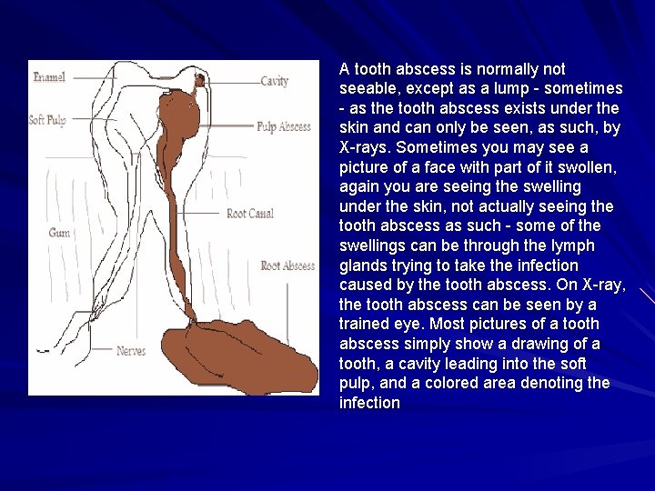 Acute apical periodontitis parodontitis apicalis acuta etiology ...