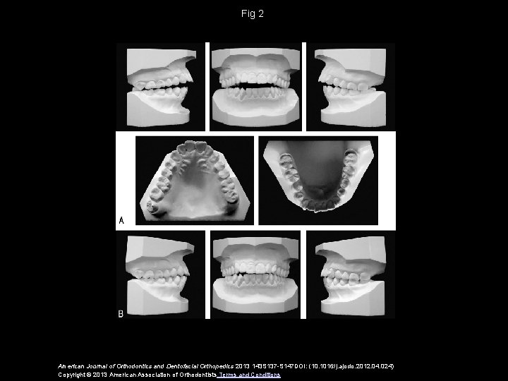 Severe open bite due to traumatic condylar fractures