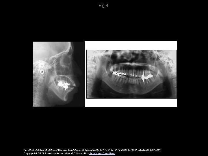 Severe open bite due to traumatic condylar fractures