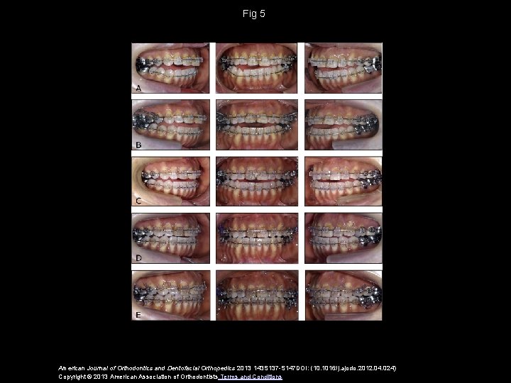 Severe open bite due to traumatic condylar fractures