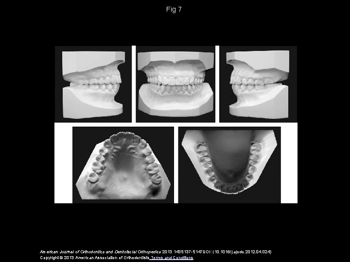 Severe open bite due to traumatic condylar fractures