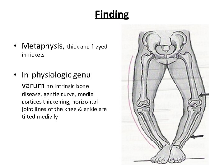GENU VALGUS GENU VARUS Natural History of normal