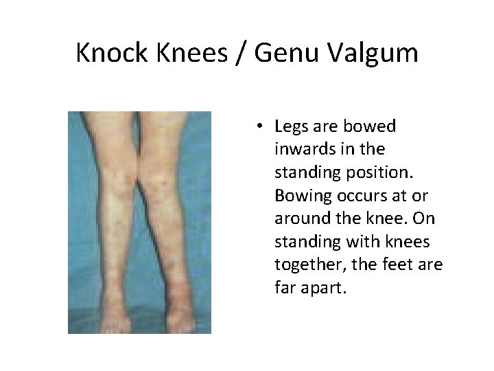 GENU VALGUS GENU VARUS Natural History of normal