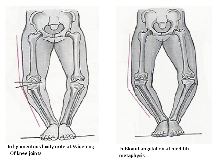 GENU VALGUS GENU VARUS Natural History of normal