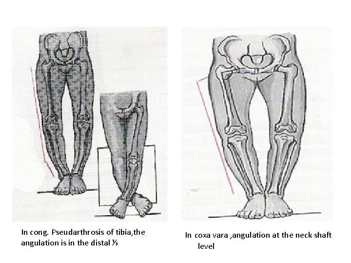 GENU VALGUS GENU VARUS Natural History of normal