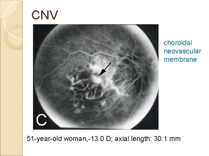 EBM Journal reading Longterm Pattern of Progression of