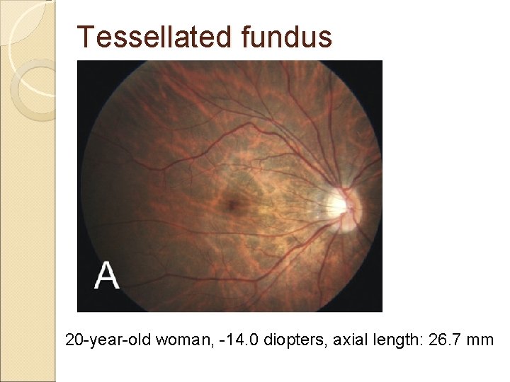 EBM Journal reading Longterm Pattern of Progression of