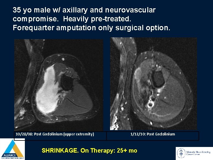 SorafenibNexavar in Desmoid tumors Mrinal Gounder M D