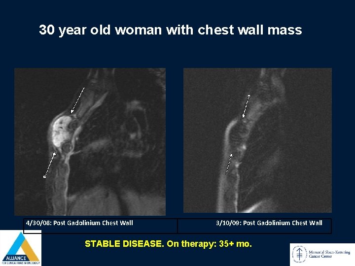 SorafenibNexavar in Desmoid tumors Mrinal Gounder M D