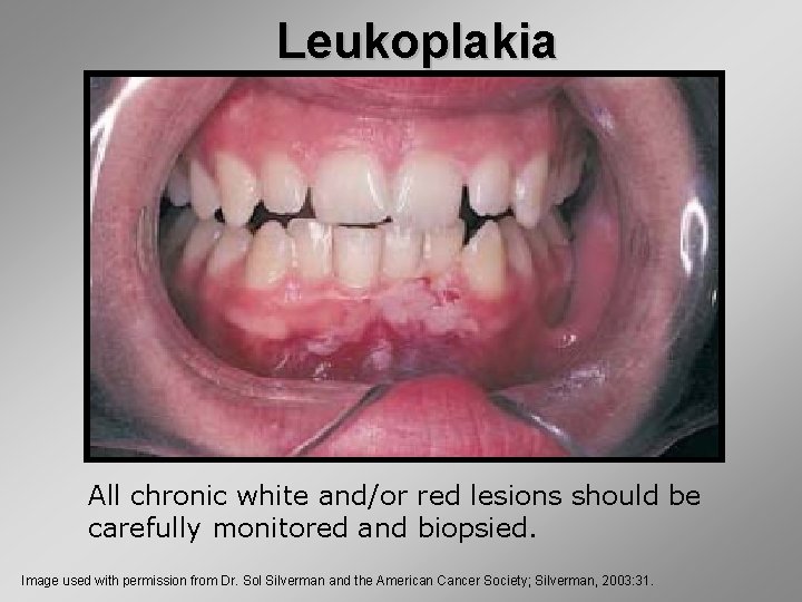 Module 3 Clinical Manifestations Introduction Intraoral cancers occur