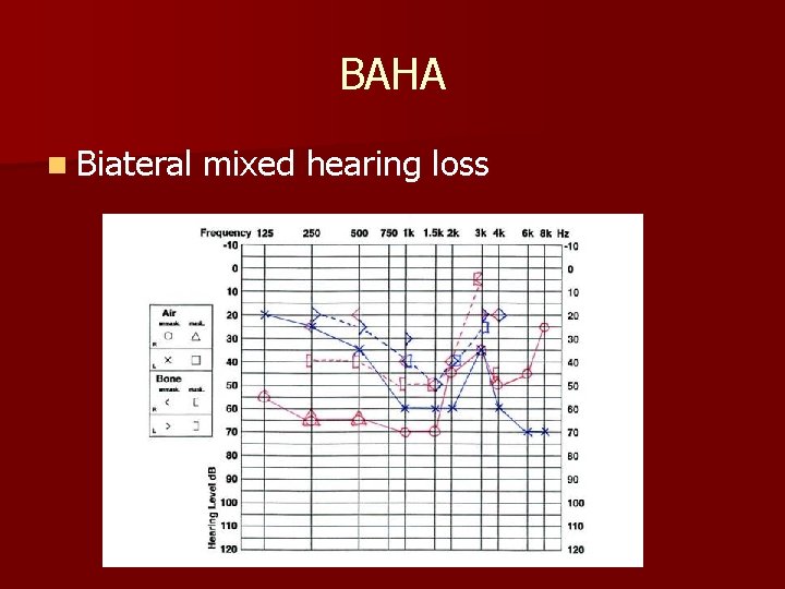 Bone Anchored Hearing Aids Dr Amir Soltani Clinical