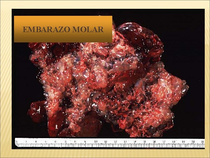 EMBARAZO MOLAR En un embarazo molar la placenta