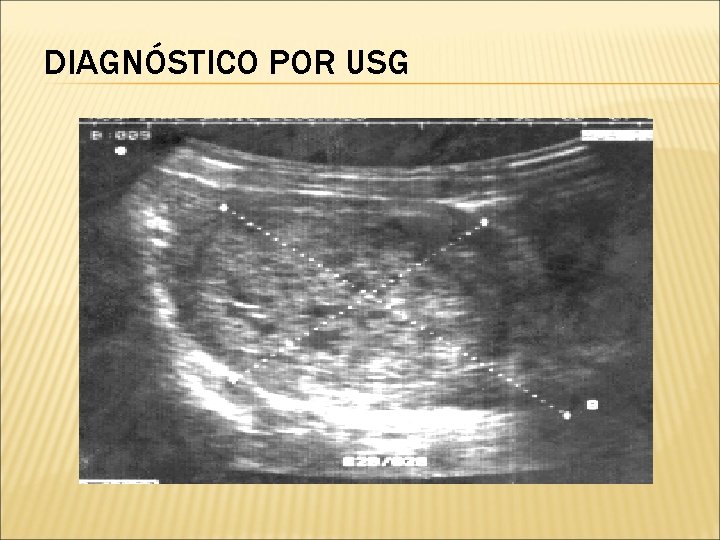 EMBARAZO MOLAR En un embarazo molar la placenta