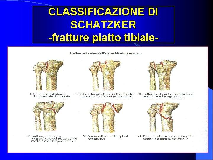 La riabilitazione funzione deambulatoria PAZIENTE CON FRATTURA DI