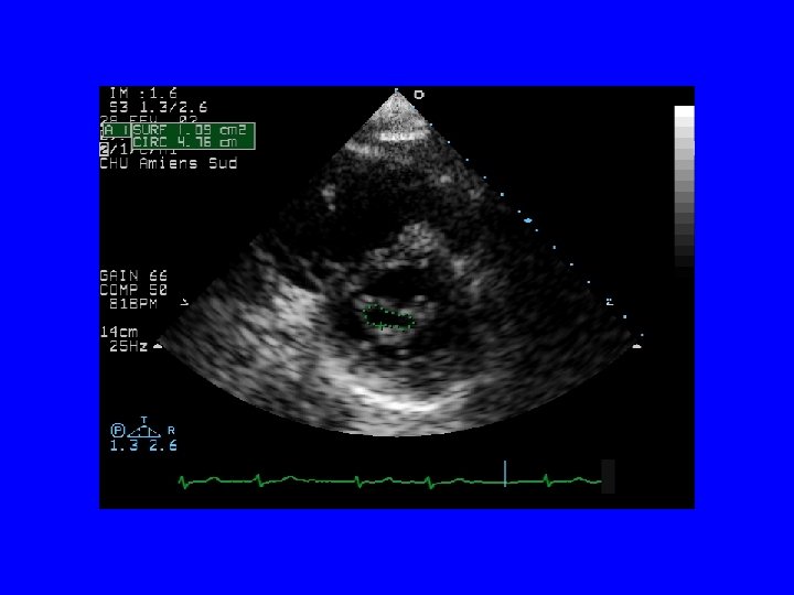 RETRECISSEMENT MITRAL C Tribouilloy I Dfinition Anatomopathologie Dfinition