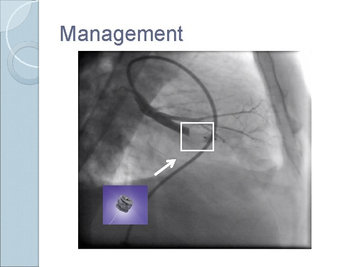 Transcatheter Embolization of a Pulmonary Arteriovenous Malformation in