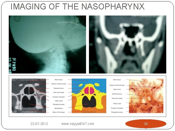 SURGICAL ANATOMY OF THE NASOPHARYNX Dr Supreet Singh