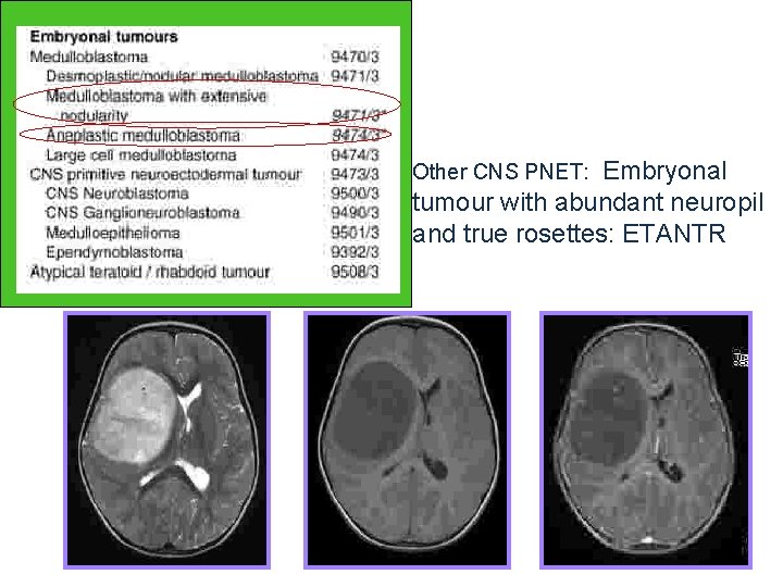 Tumeurs crbrales chez lenfant Nadine GIRARD Hpital Timone