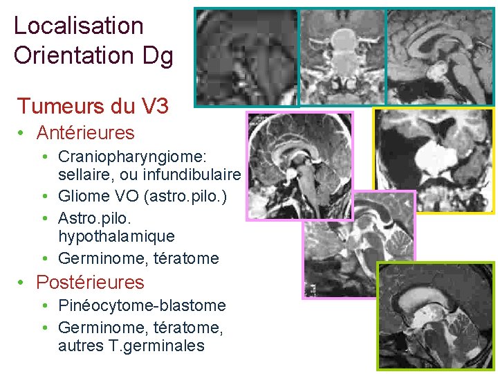 Tumeurs crbrales chez lenfant Nadine GIRARD Hpital Timone
