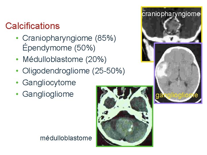 Tumeurs crbrales chez lenfant Nadine GIRARD Hpital Timone