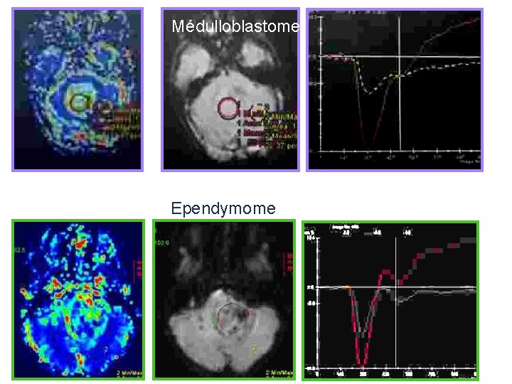Tumeurs crbrales chez lenfant Nadine GIRARD Hpital Timone