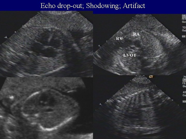 Pitfalls in Fetal Echocardiography Jung Yun Choi Department