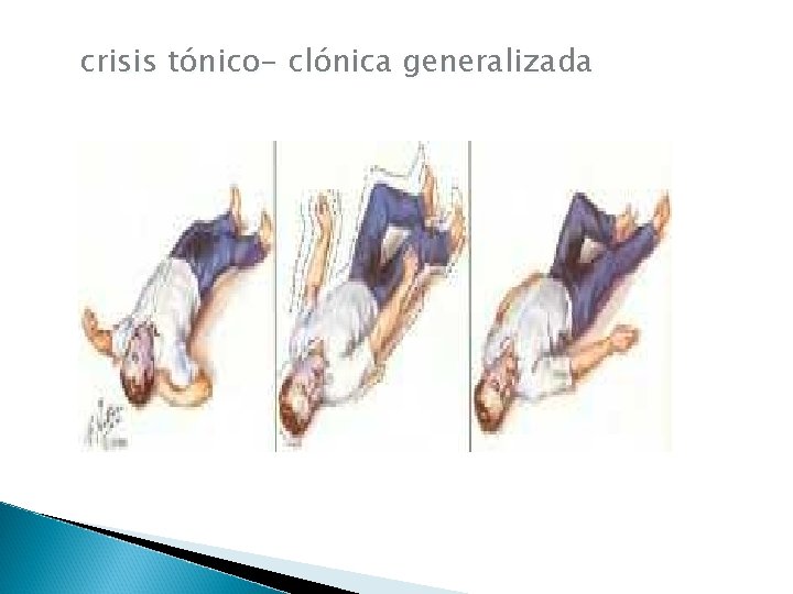 Crisis epilptica y epilepsia Clasificacin diagnstico y tratamiento