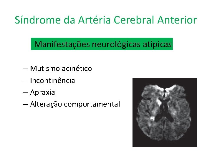 Sndromes Clnicas do Acidente Vascular Cerebral Uma abordagem