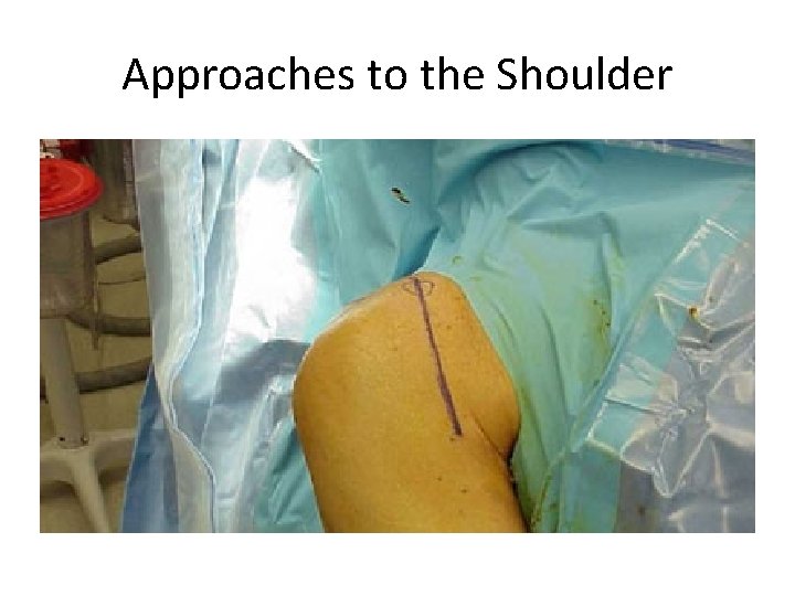 Surgical Approaches to the Shoulder Mr O Obakponovwe