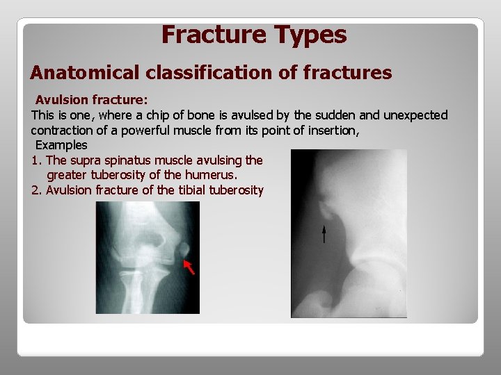 RAD 422 Lecture 4 Fractures Types Complications and