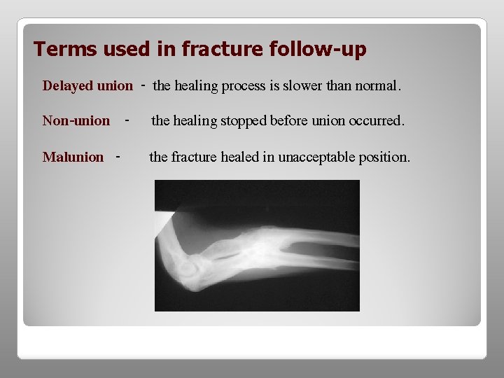 RAD 422 Lecture 4 Fractures Types Complications and