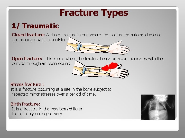 RAD 422 Lecture 4 Fractures Types Complications and