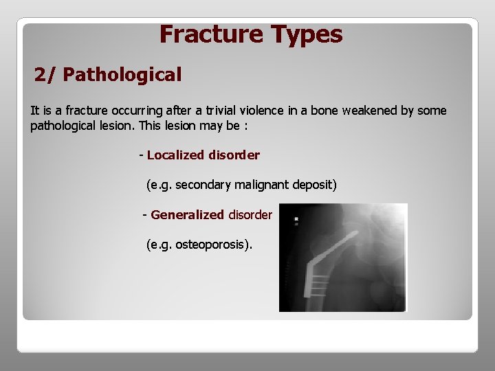 RAD 422 Lecture 4 Fractures Types Complications and