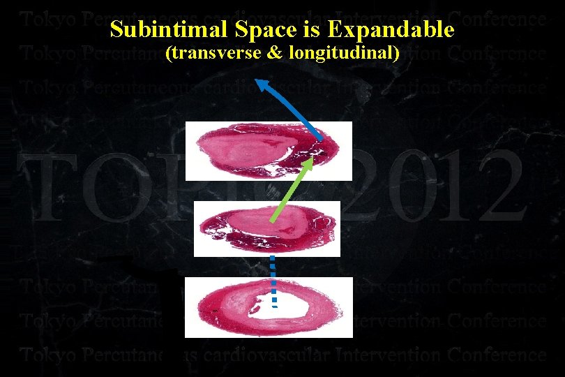 Recent Advances of Antegrade and Retrograde PCI for