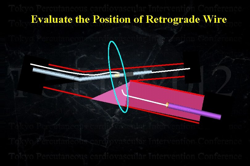 Recent Advances of Antegrade and Retrograde PCI for