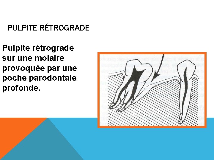 Maladies de la pulpe MALADIE DE LA PULPE