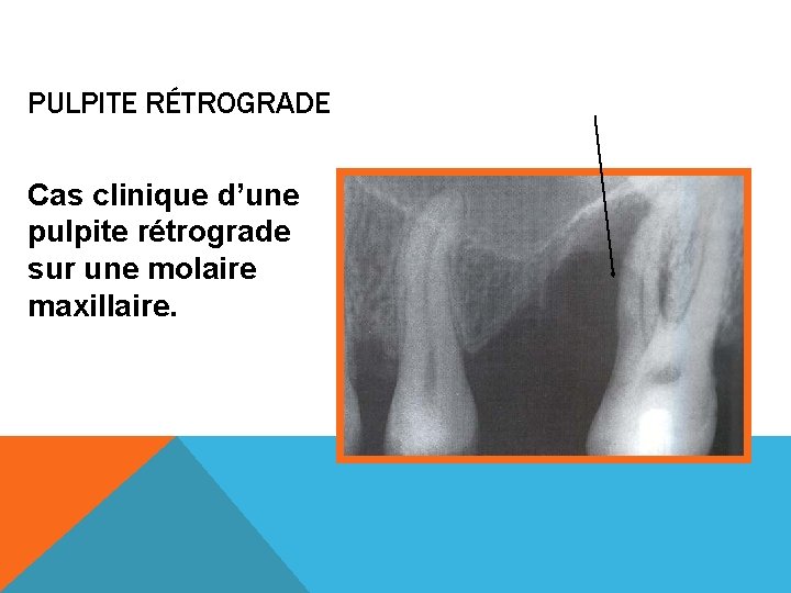 Maladies de la pulpe MALADIE DE LA PULPE