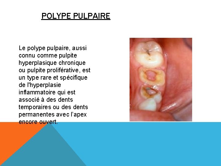 Maladies de la pulpe MALADIE DE LA PULPE