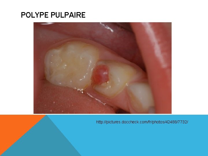 Maladies de la pulpe MALADIE DE LA PULPE