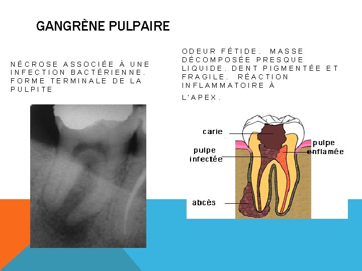 Maladies de la pulpe MALADIE DE LA PULPE