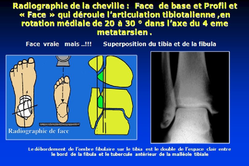 TRAUMATISMES DE LA CHEVILLE Traumatismes de la cheville