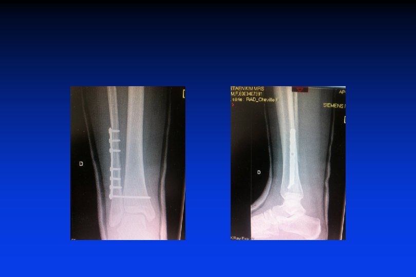 TRAUMATISMES DE LA CHEVILLE Traumatismes de la cheville