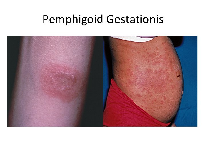 Pruritus in Pregnancy Carol Mendez MD Albert Einstein